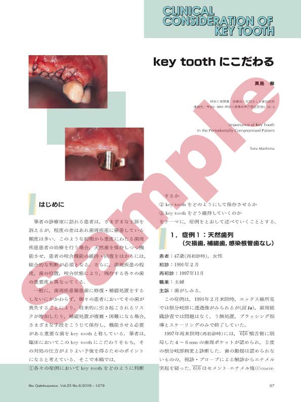 CLINICAL CONSIDERATION OF KEY TOOTH:key toothにこだわる - クインテッセンス出版